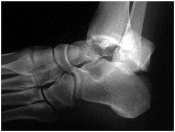 Talar Neck Fractures - Trauma - Orthobullets